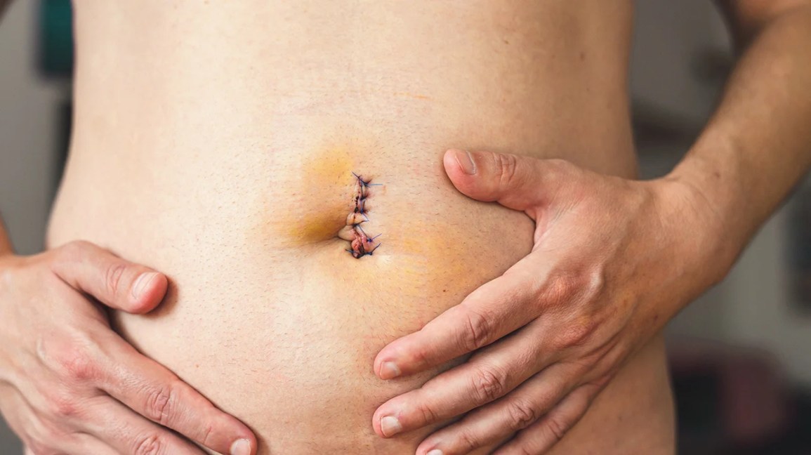 Stitches – Blue Water Urgent Care – Algonac